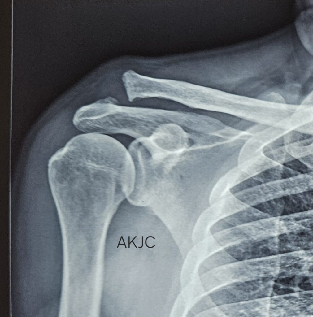 Acromio Clavicular Joint Reconstruction (ACJR) Surgery in Indore